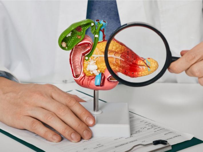 Tumore del pancreas: casi in aumento. La diagnosi precoce può fare la ...